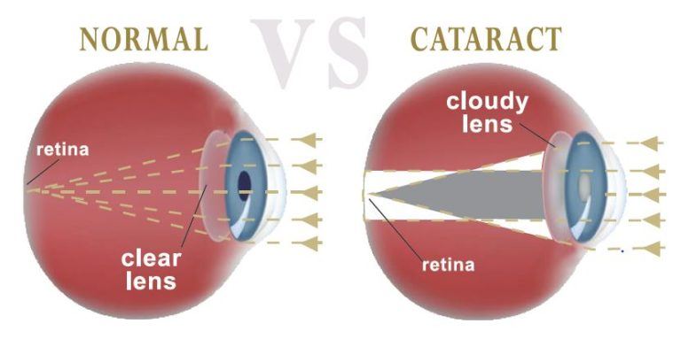 Common Problems Caused by Cataracts | ReVision